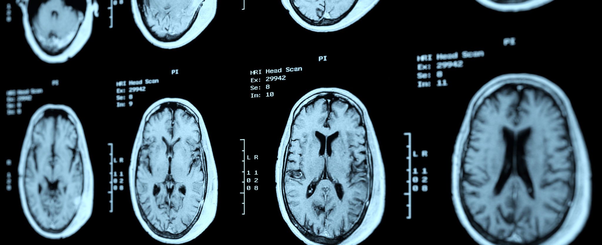 Brain Tumor Patient and Caregiver Guide