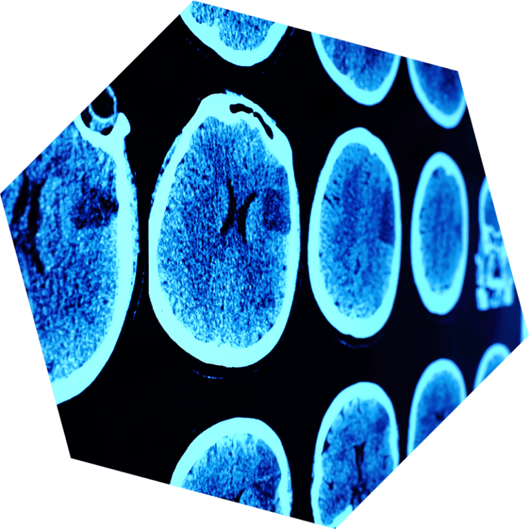 Neuroimaging | Ivy Brain Tumor Center